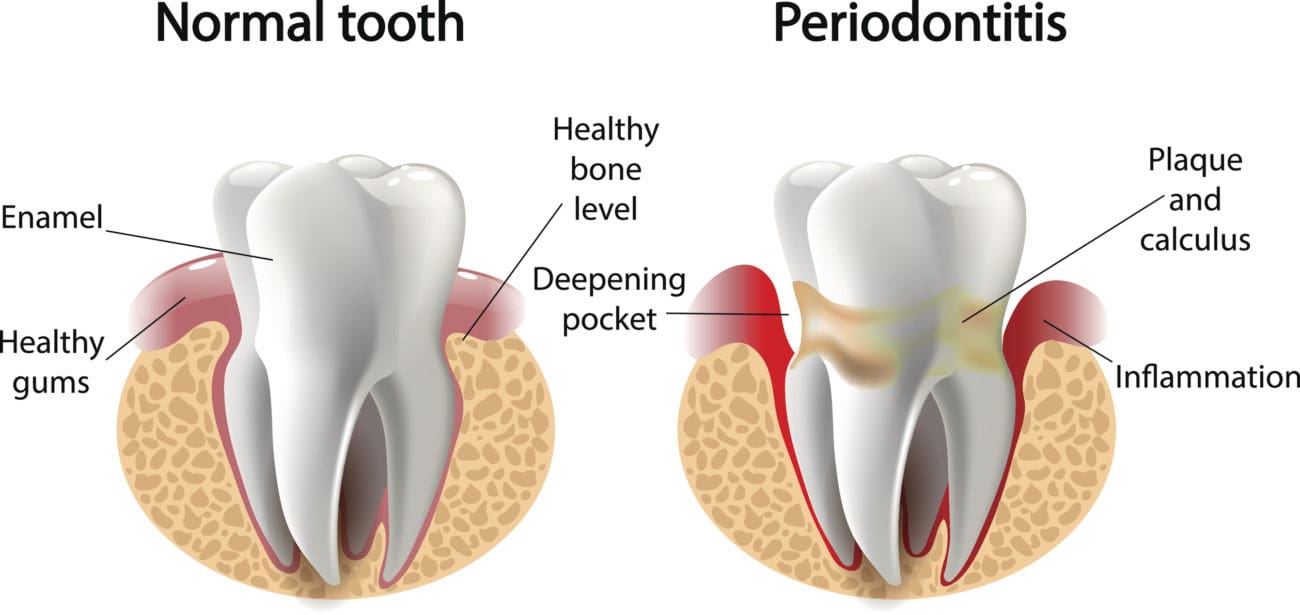 Gum Disease & Tooth Loss | Shippensburg PA Dentist